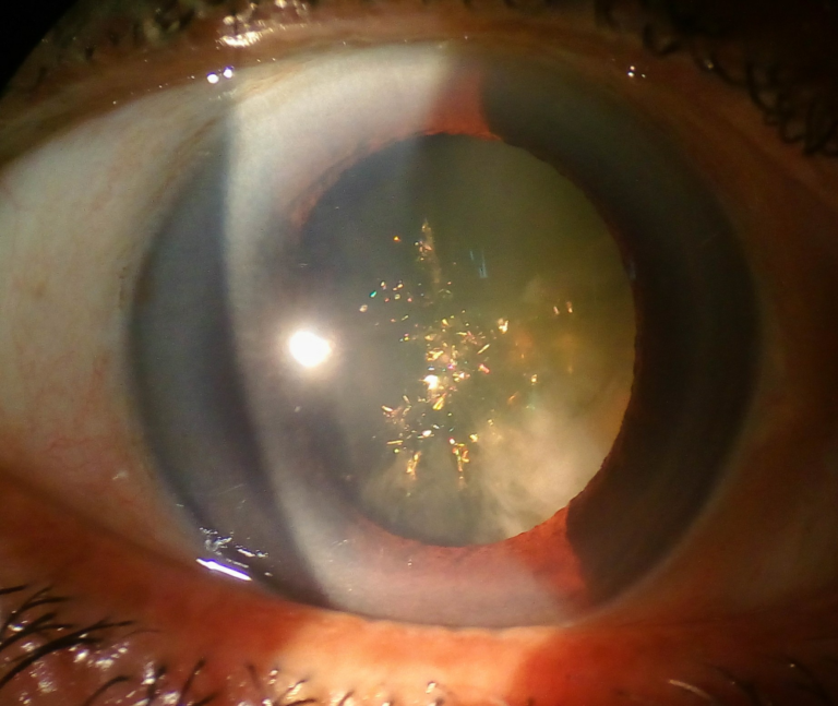 Christmas Tree Cataract causes and treatment - An Eye Care Blog