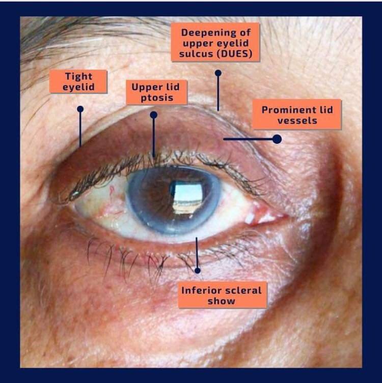 Prostaglandin Associated Periorbitopathy(PAP) - An Eye Care Blog
