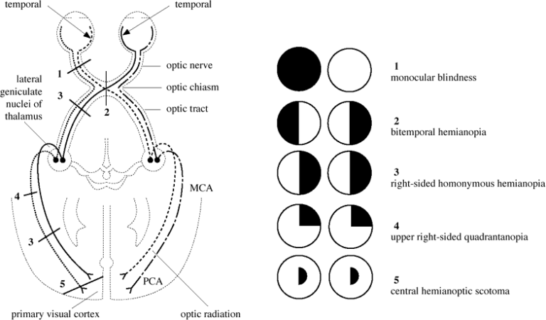 A Brain stroke can cause Hemianopia-partial or complete blindness. - An ...