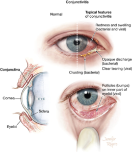Types of pink eye, the 3 types of conjunctivitis and differential ...