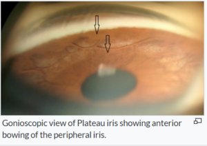 Plateau iris syndrome - An Eye Care Blog