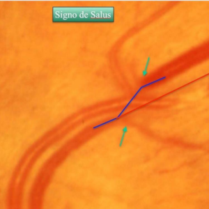Gunn's sign and salus sign in Hypertensive retinopathy. - An Eye Care Blog