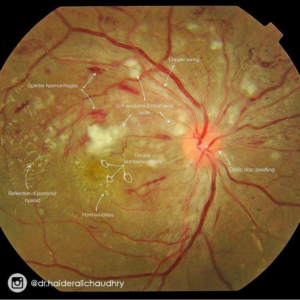 Hypertensive Retinopathy clinical finding and management. - An Eye Care ...