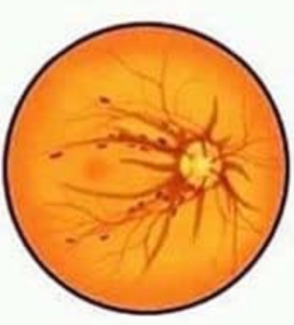 Types of Retinal Hemorrhages and its treatment. - An Eye Care Blog