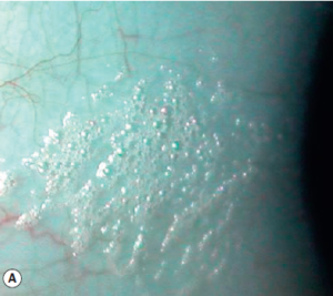 What is xerophthalmia & how is it treated? - An Eye Care Blog