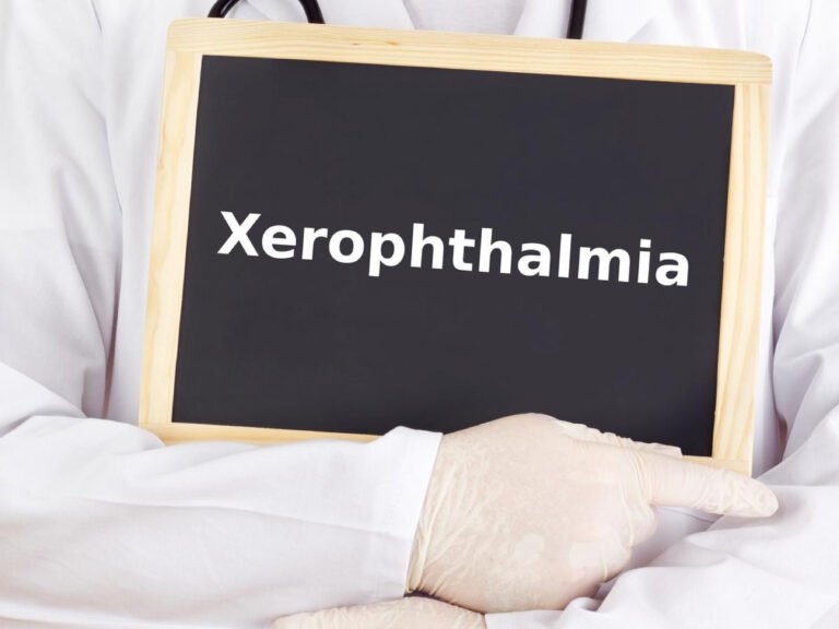What is xerophthalmia & how is it treated? - An Eye Care Blog
