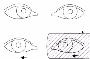 What are Heterophoria symptoms and treatment available? - An Eye Care Blog