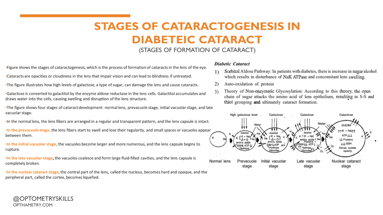 Diabetic Cataract, Infograph. - An Eye Care Blog