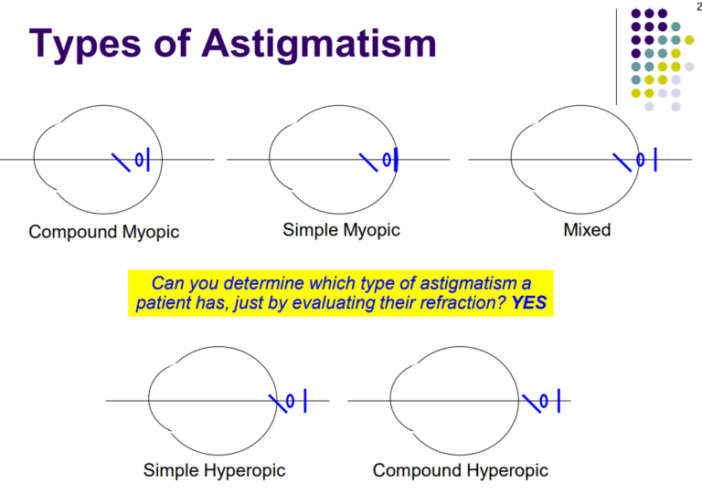 What is Mixed Astigmatism? - An Eye Care Blog