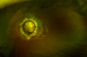 Optic Disc Abnormalities: Diagnosis, Types and Impact on Vision - An ...