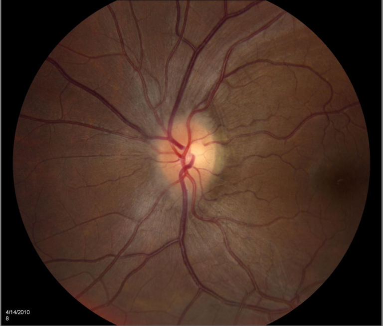 Optic Disc Abnormalities: Diagnosis, Types and Impact on Vision - An ...