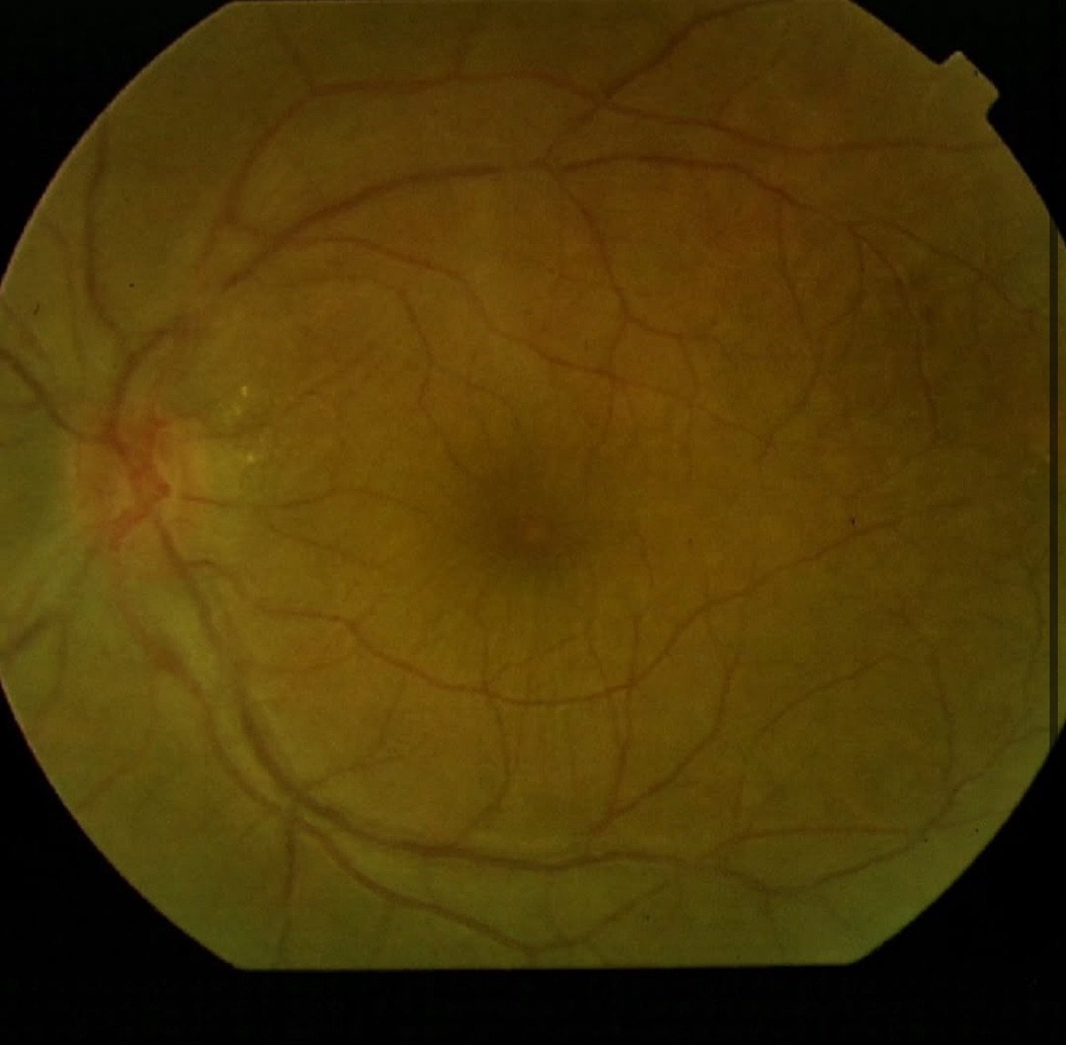 Eales Disease: A Rare Retinal Disorder with Sight-Threatening ...