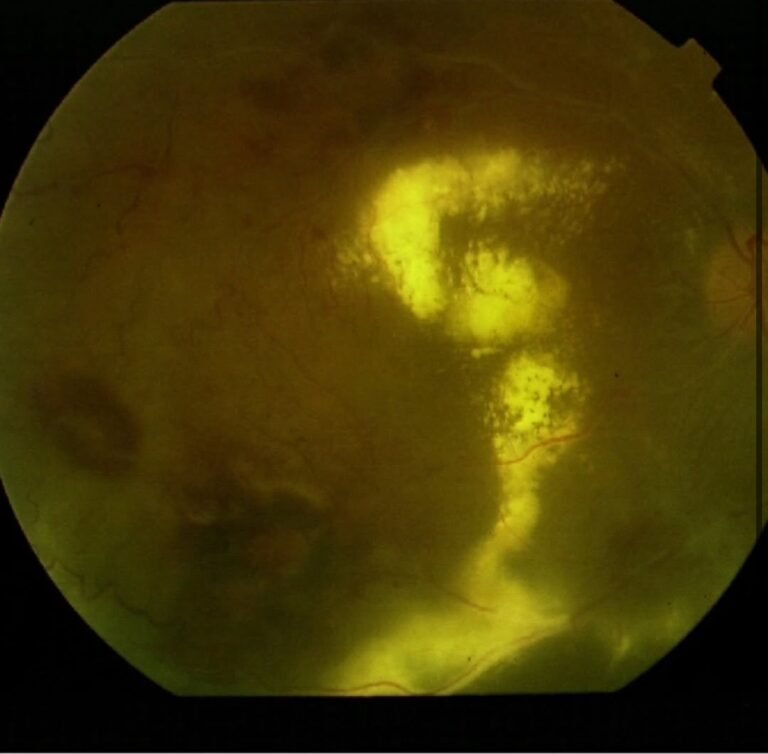 Eponymous Signs of Thyroid Ophthalmopathy - An Eye Care Blog