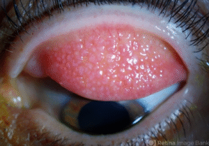 Understanding Giant Papillary Conjunctivitis - An Eye Care Blog