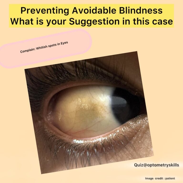 Antiviral eye drops for shingles - An Eye Care Blog