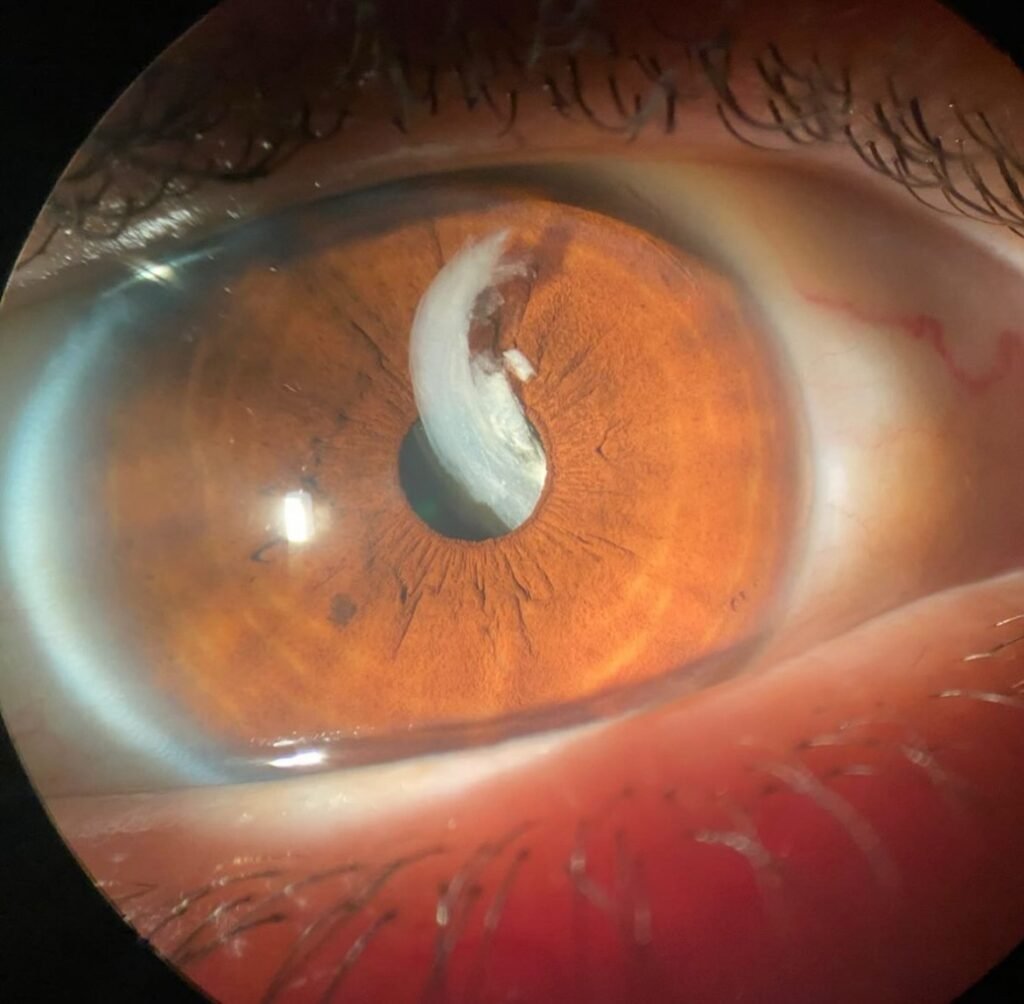 Understanding Giant Papillary Conjunctivitis - An Eye Care Blog