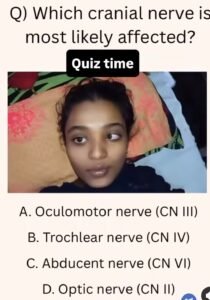 Understanding Prentice's rule and its calculation. - An Eye Care Blog