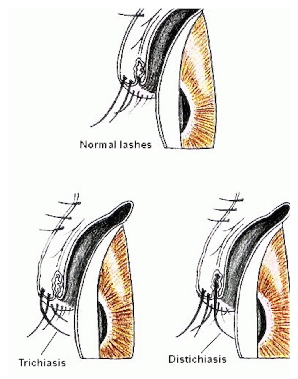 Trichiasis and Distichiasis: Understanding the Differences - An Eye ...