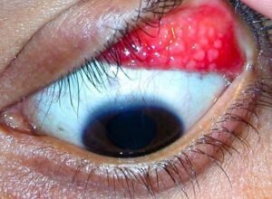 Giant Papillary Conjunctivitis (GPC): Clinical Features, Causes, and ...