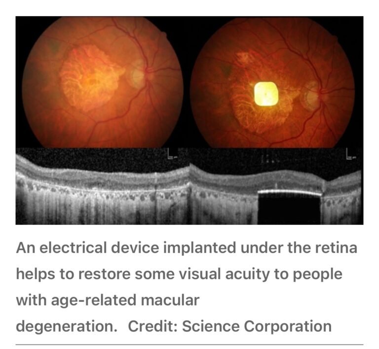 Breakthrough in Vision Restoration: The PRIMA Bionic Chip Lets Blind ...