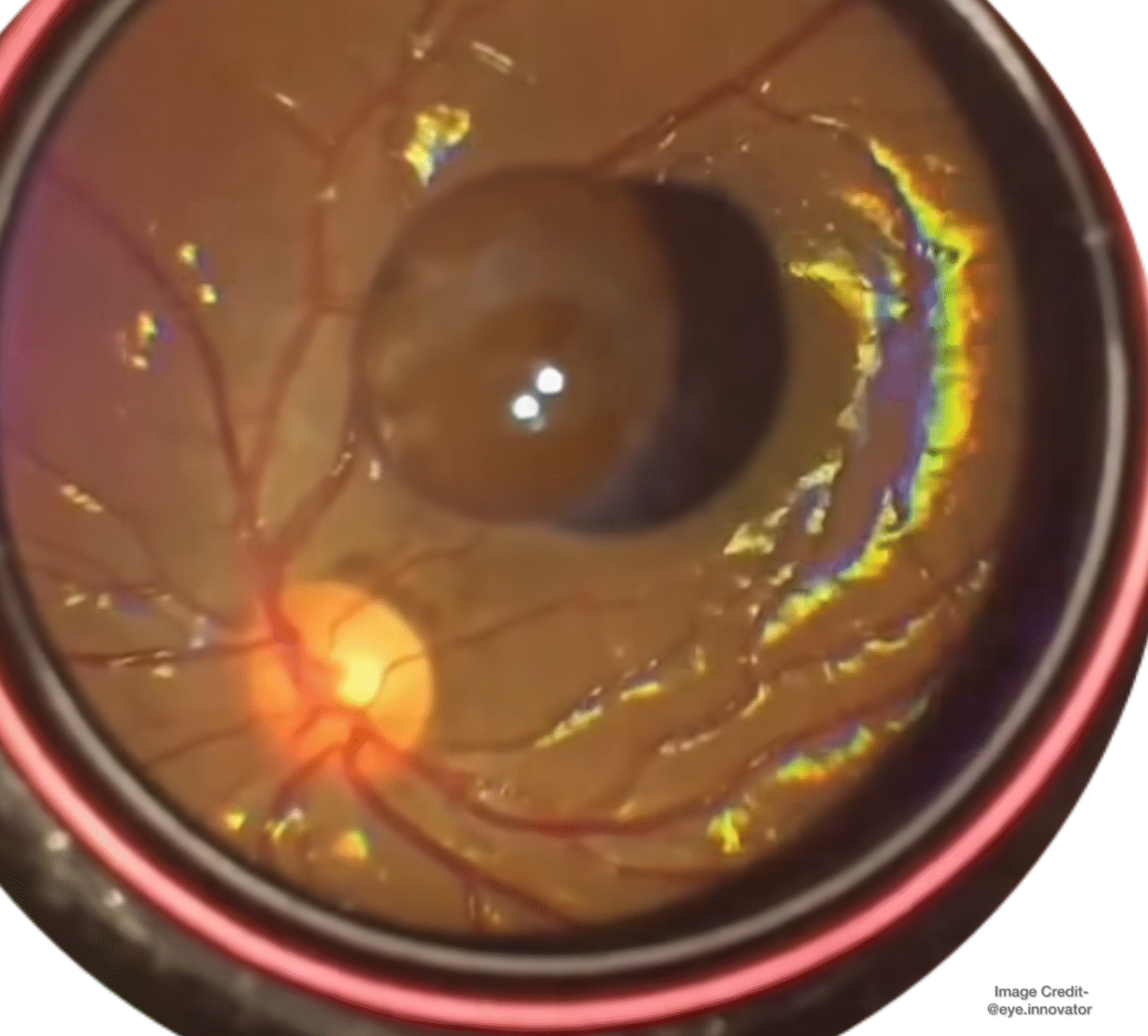 Vitreous Cyst: A Rare and Fascinating Ocular Finding - An Eye Care Blog