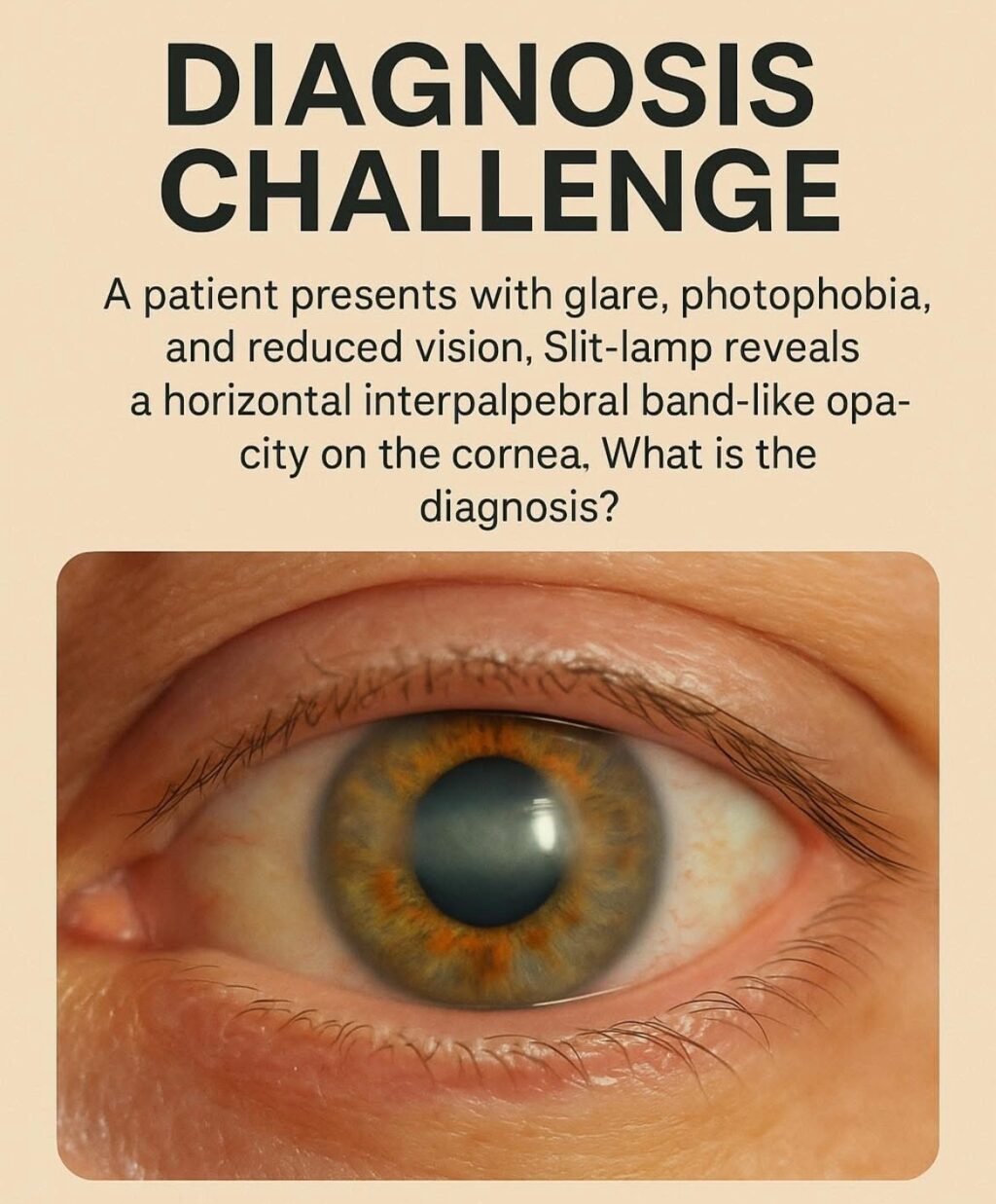 What is Calcific Band Keratopathy? - An Eye Care Blog