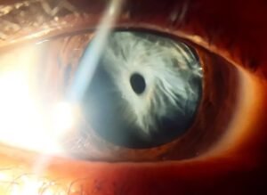 Understanding Prentice's rule and its calculation. - An Eye Care Blog