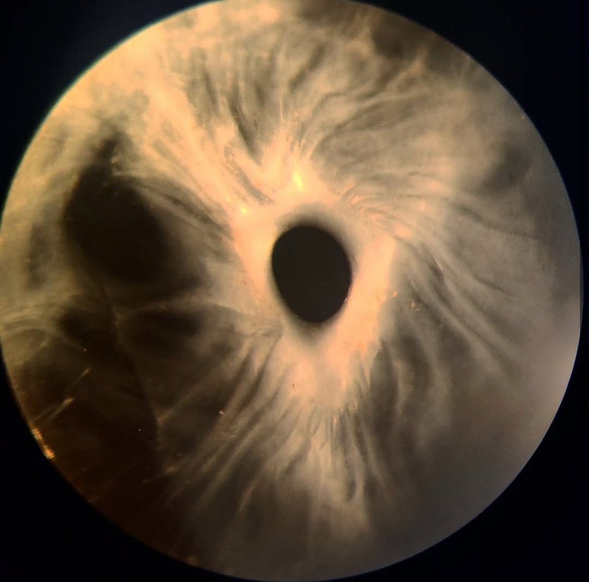 What is Anterior Capsular Phimosis After Cataract Surgery - An Eye Care ...