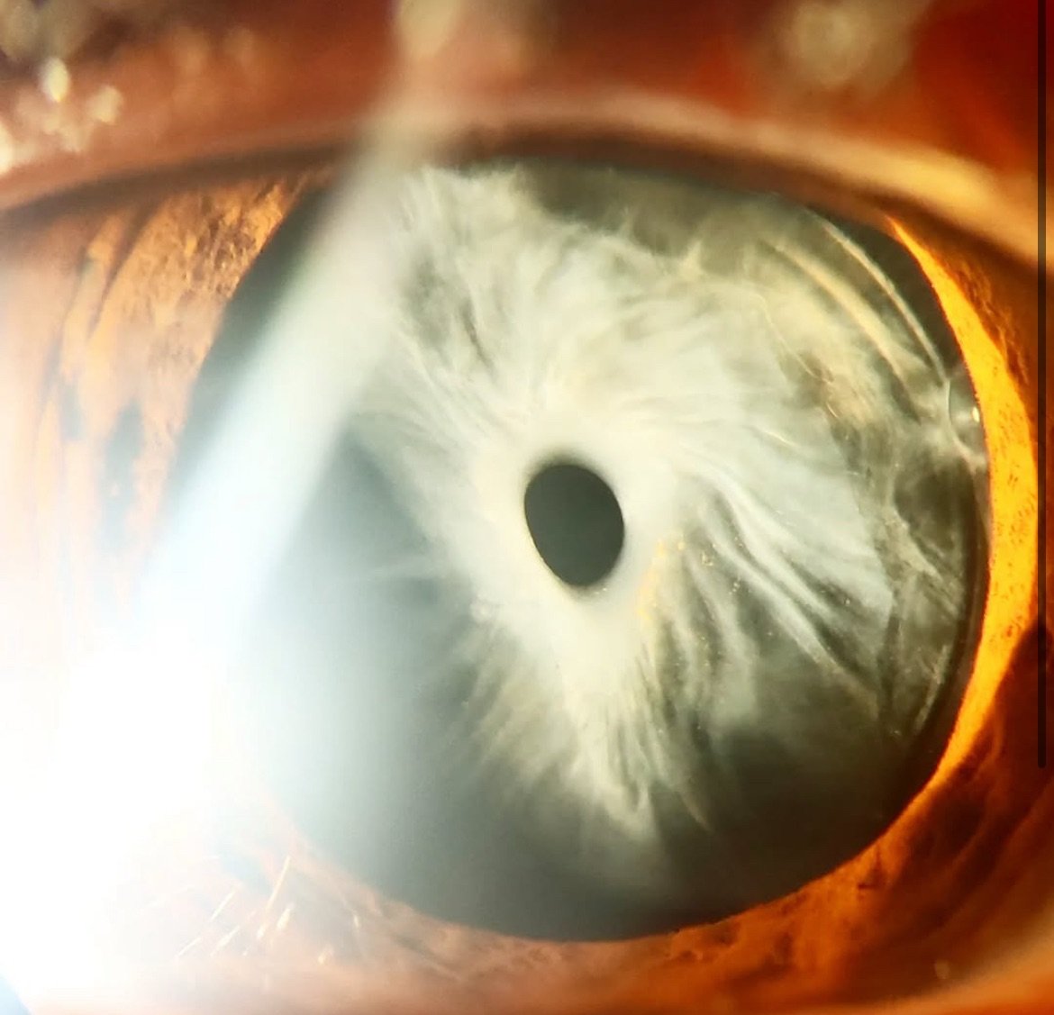 What is Anterior Capsular Phimosis After Cataract Surgery - An Eye Care ...